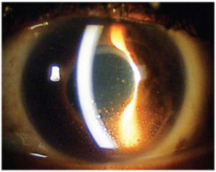 Herpes Zoster Ophthalmicus Cornea